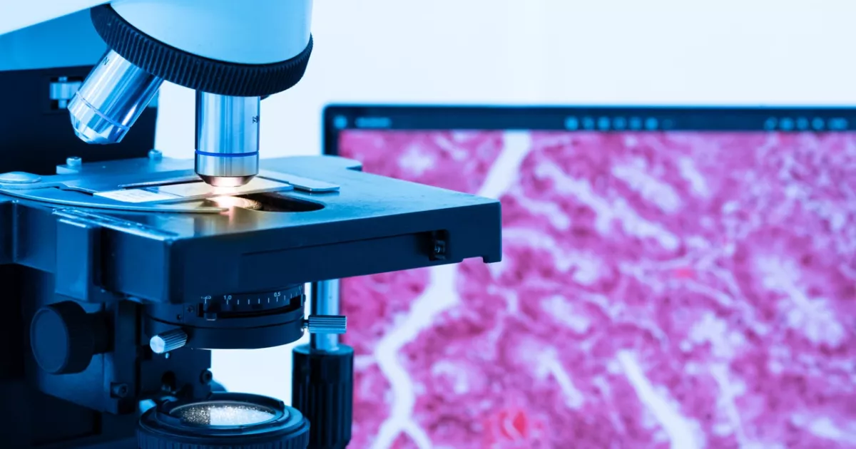 Etapas del cáncer colorrectal | Alianza contra el cáncer colorrectal